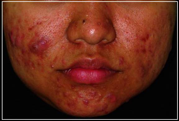 Cystic acne treatment, discover 4 principles of effective intervention ...